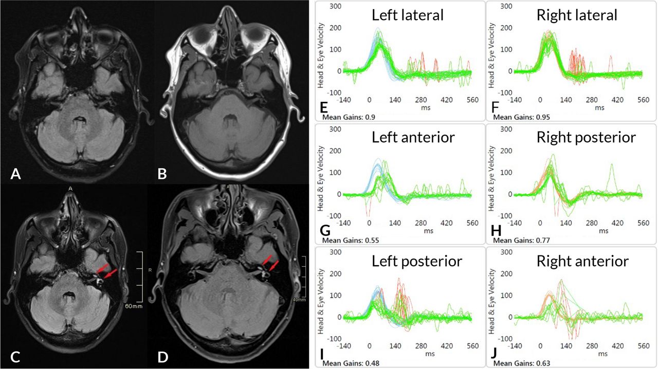 Sudden unilateral audiovestibular loss due to acute labyrinthine ...