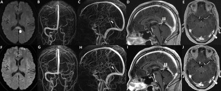Cytotoxic lesions of the corpus callosum (CLOCCs) with a flow gap in ...