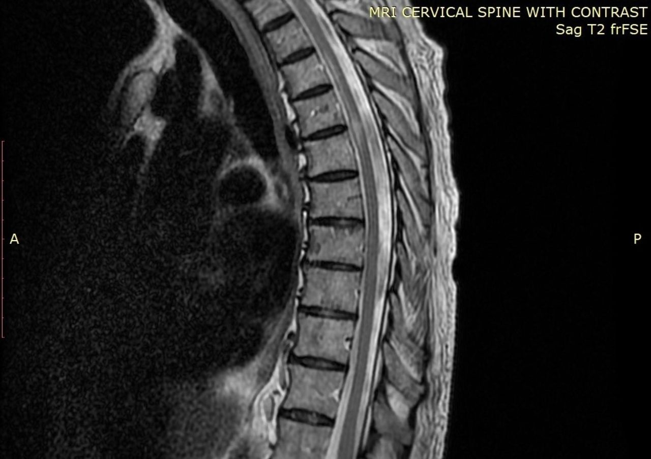 Anterior Spinal Artery Syndrome After Bronchial Embolization for ...