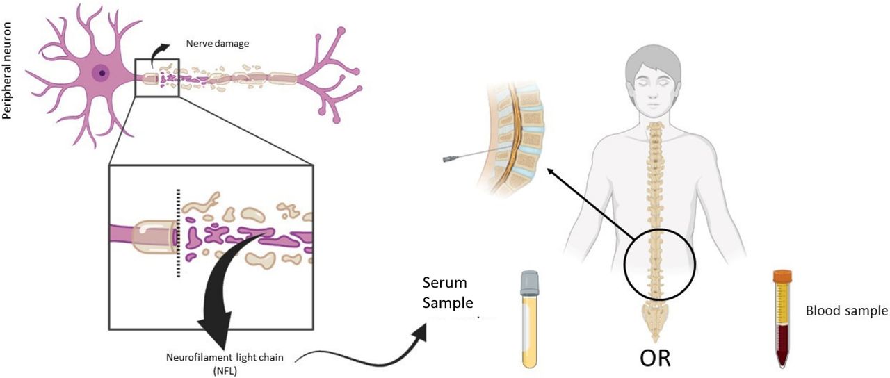 Assessment of axonal injury in multiple sclerosis: combined analysis of ...