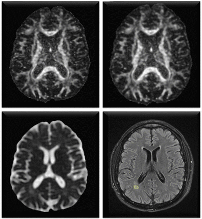 Assessment of axonal injury in multiple sclerosis: combined analysis of ...