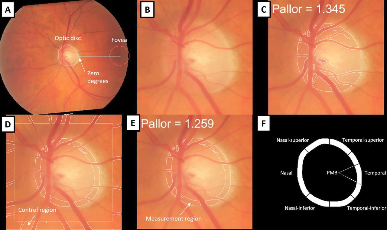 Association between optic disc pallor and lacunar stroke | BMJ ...