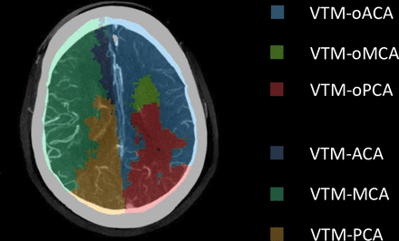 Validation of CT perfusion-based vascular territory mapping ...