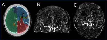 Validation of CT perfusion-based vascular territory mapping ...