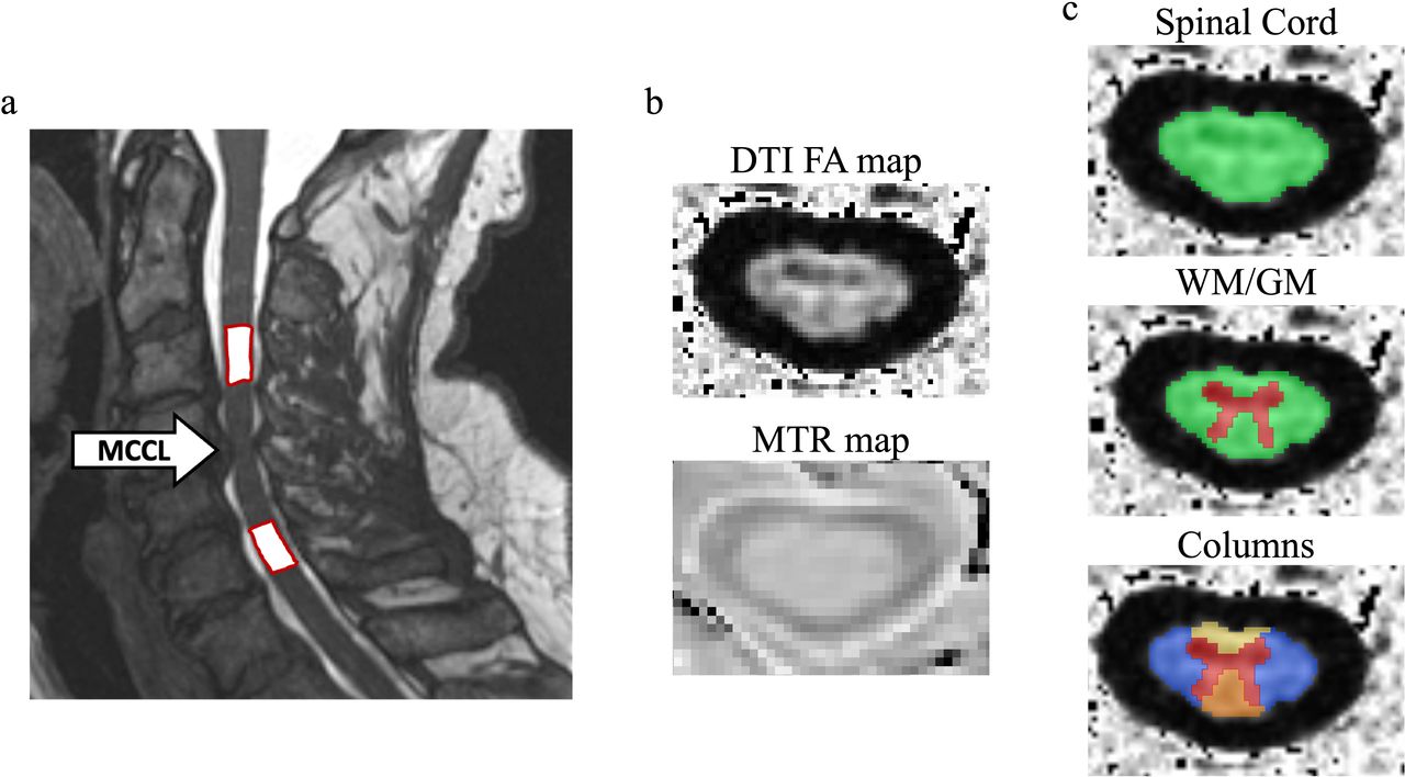 Spinal cord demyelination predicts neurological deterioration in ...