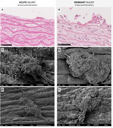 Vascular injury and occurrence of microthrombi after endovascular ...