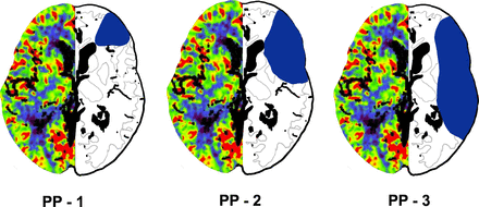 Perfusion patterns as a tool for emergency stroke diagnosis ...
