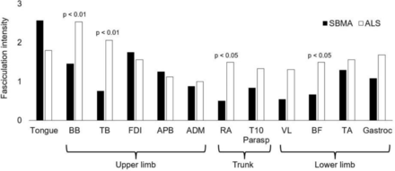 Different patterns of fasciculation in spinal and bulbar muscular ...