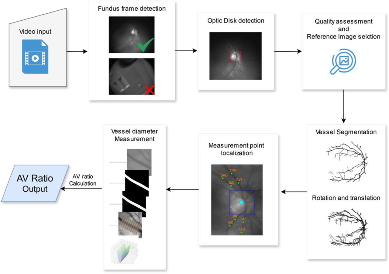 Fundoscopy as a diagnostic biomarker in idiopathic normal pressure ...