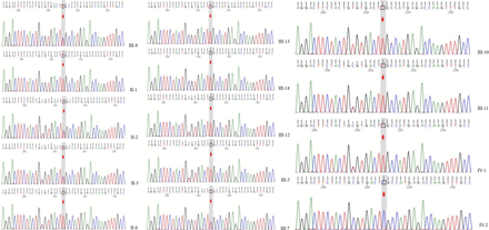 Clinical and genetic analysis of a family with myopathy caused by an ...