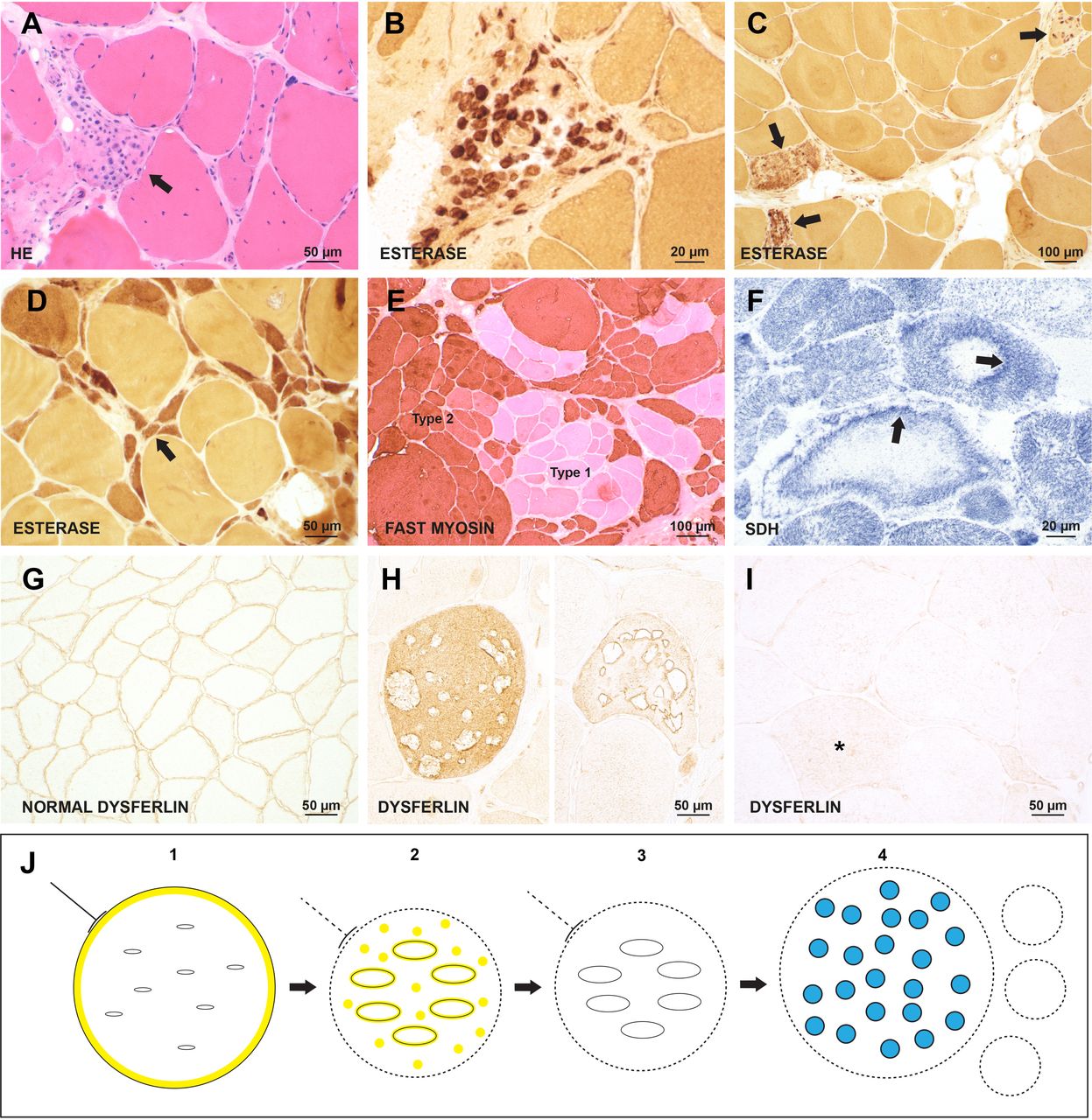 Severe hyperCKaemia and decreased sarcolemmal dysferlin in VRK1 ...