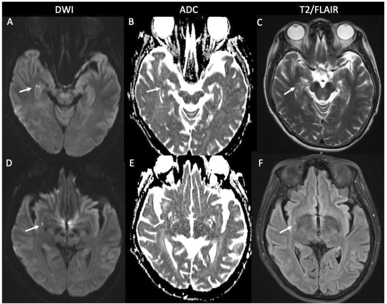 Exploring transient global amnesia: a 14-year retrospective study of ...