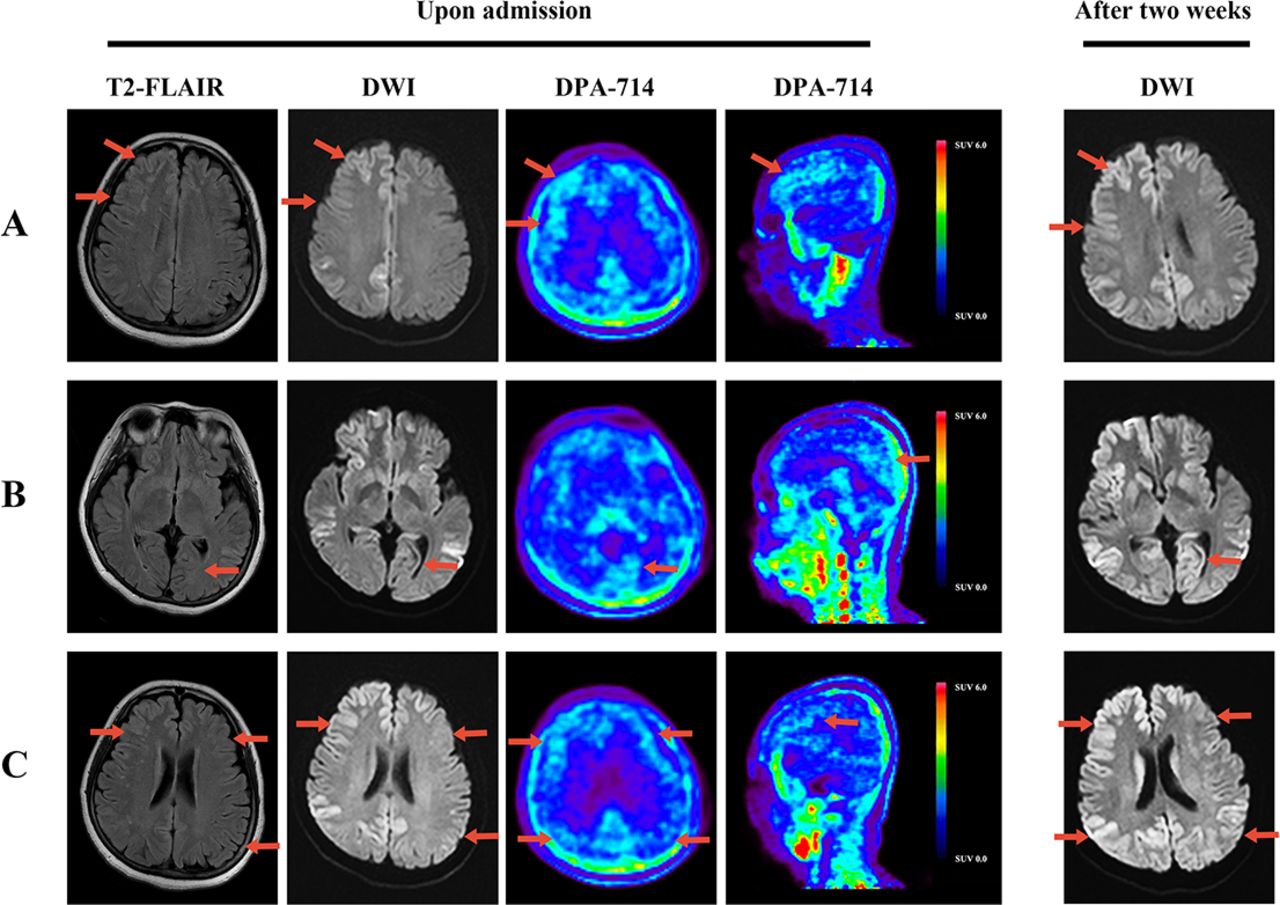 18F-DPA-714 PET/MRI reveals early and widespread neuroinflammation in ...